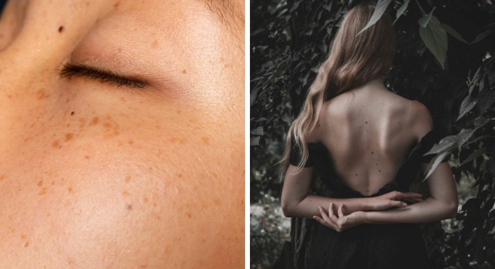 Lunares que pican o sangran: cuándo debes acudir al dermatólogo - TVC